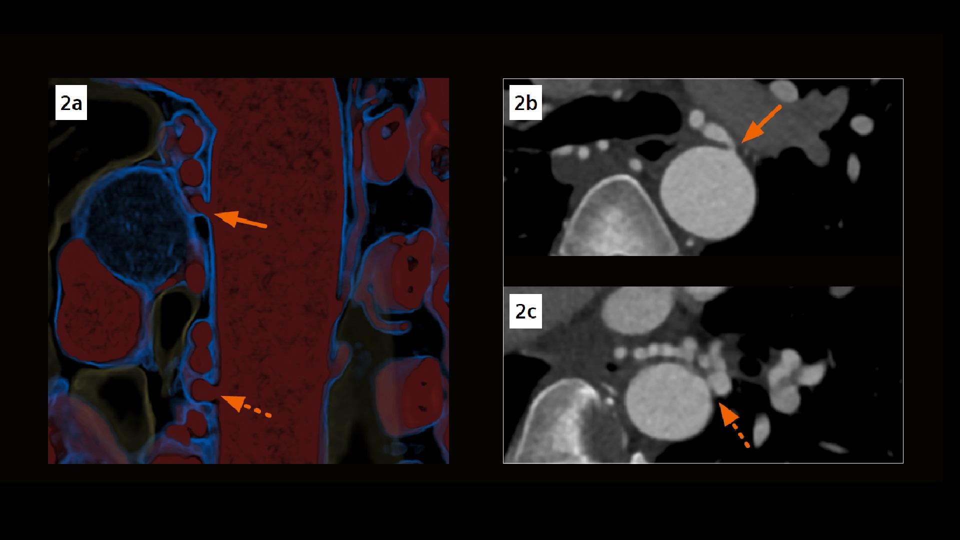Hemoptysis secondary to systemic vascular hypertrophy and bronchial ...