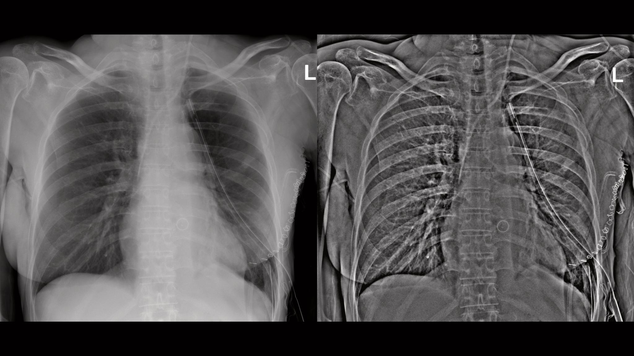 MOBILETT Impact - Siemens Healthineers