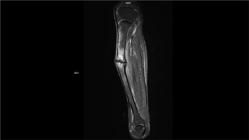 Sagittal STIR-MAGNETOM Altea - Siemens Healthineers USA