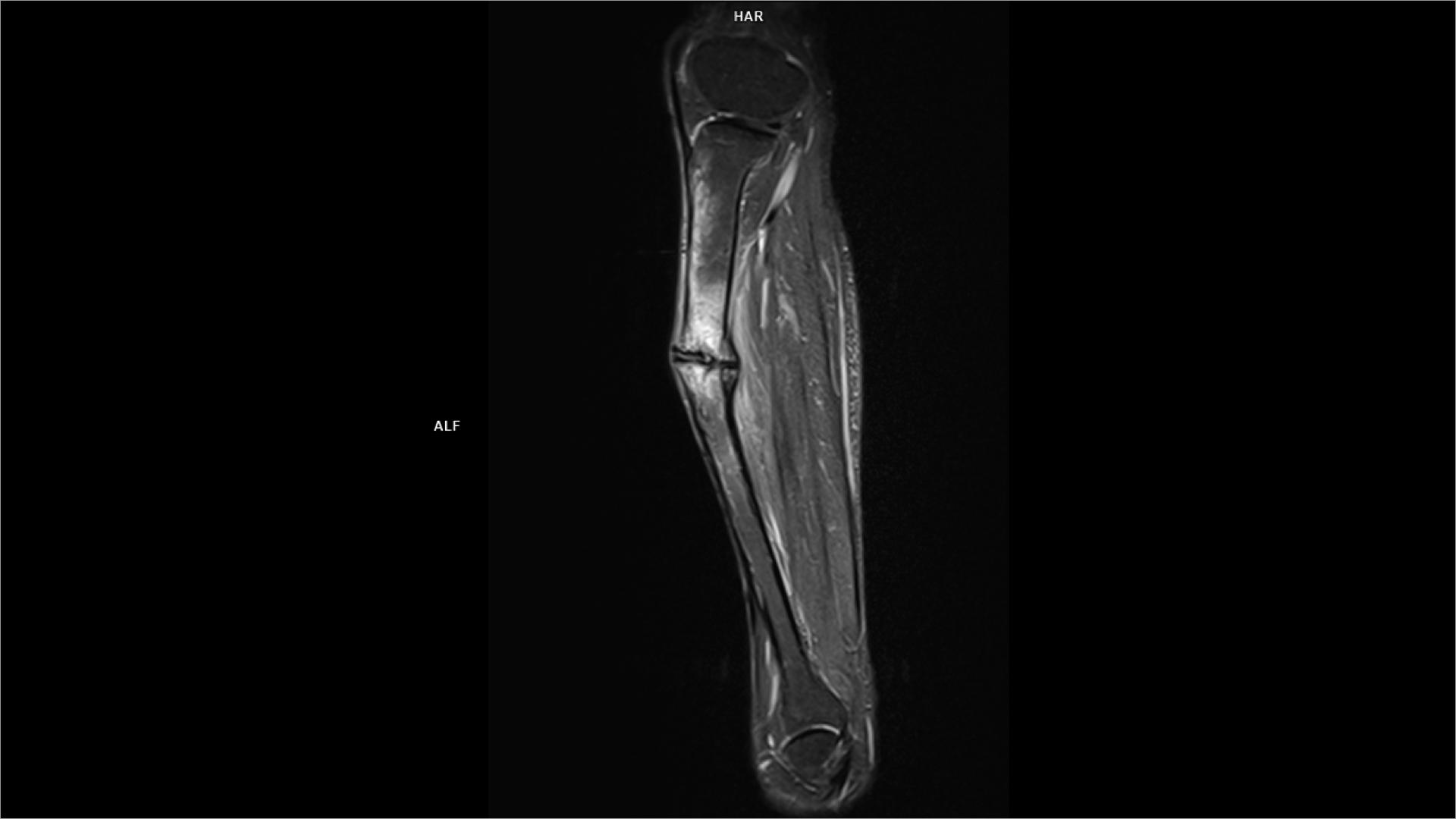 Sagittal STIR-MAGNETOM Altea - Siemens Healthineers USA