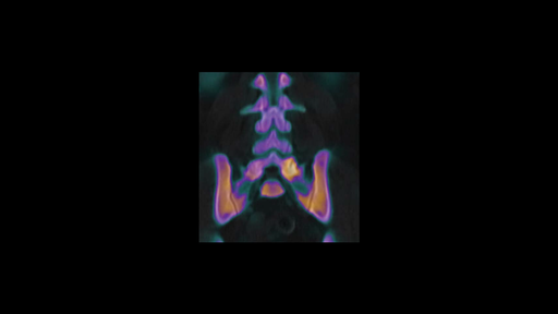 The use of SPECT/CT in a musculoskeletal Physical Medicine and ...