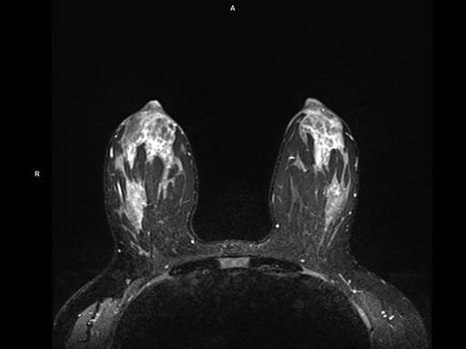 NeoCoil - Siemens Healthineers USA