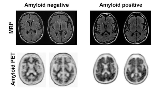 Radiopharma on neurology - Siemens Healthineers