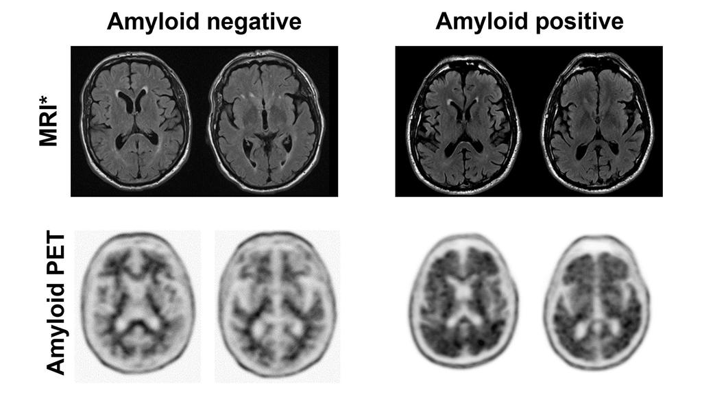 PETNET on neurology - Siemens Healthineers USA