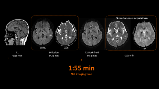Rapid Stroke Diagnosis with Deep Resolve Swift Brain Protocol: A Case ...