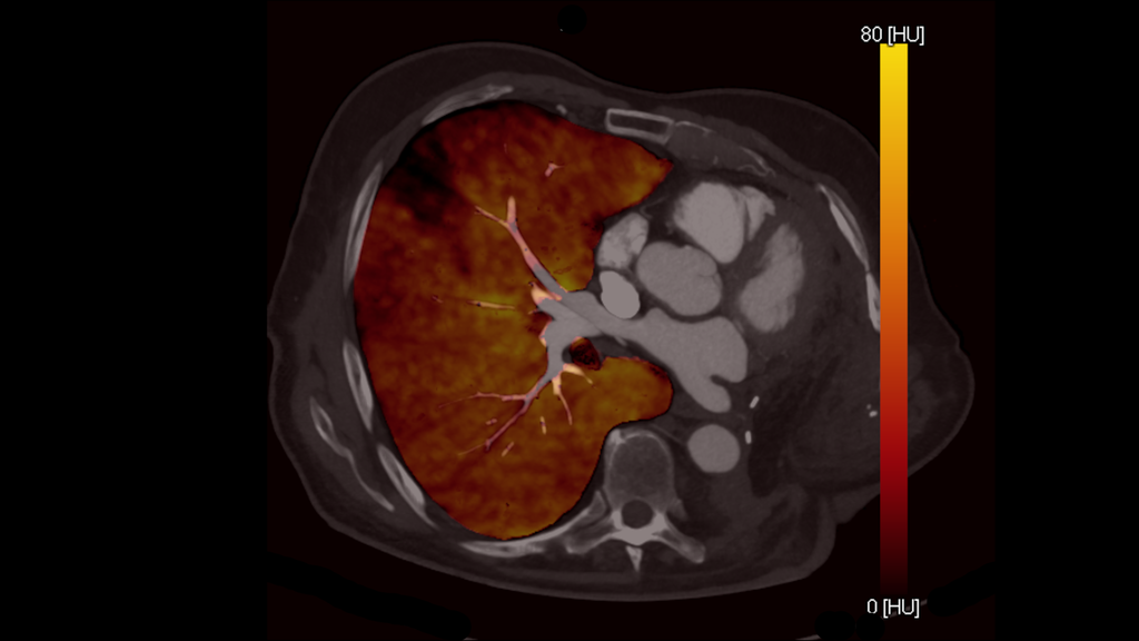 Dual Energy Ct Spectral Imaging Siemens Healthineers Usa