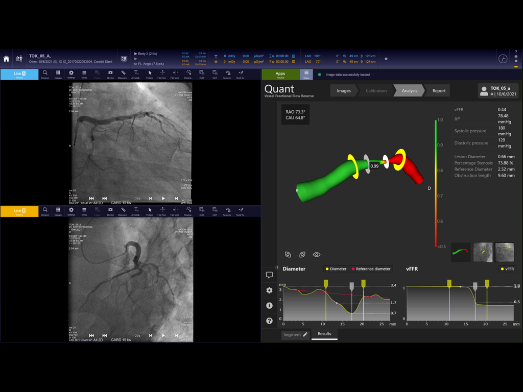 Angiography - Clinical Software Applications - Siemens Healthineers India