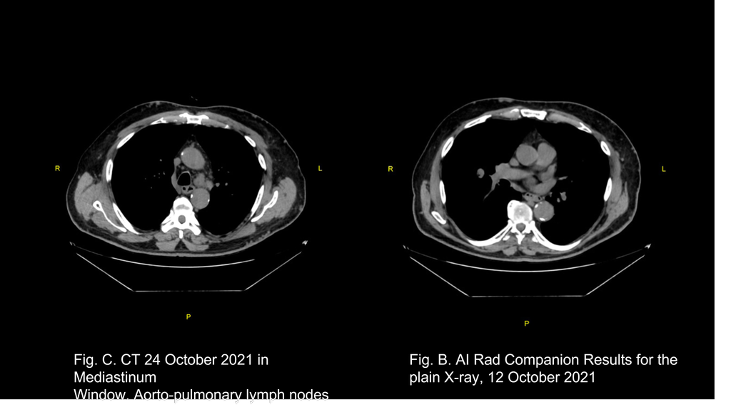 How AI can increase accuracy in Chest X-ray and enhance incidental findings