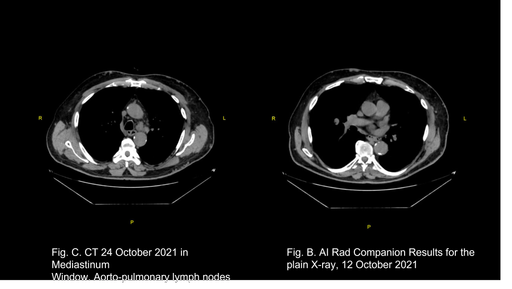 How AI can increase accuracy in Chest X-ray and enhance incidental findings