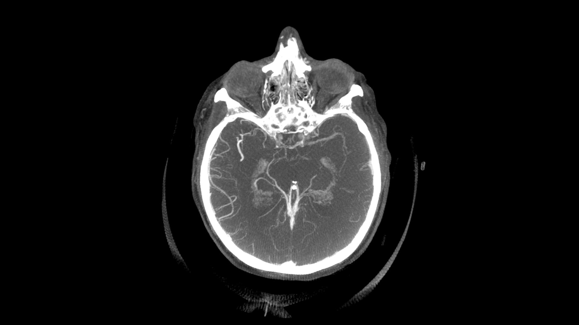 syngo DynaCT - Siemens Healthineers USA