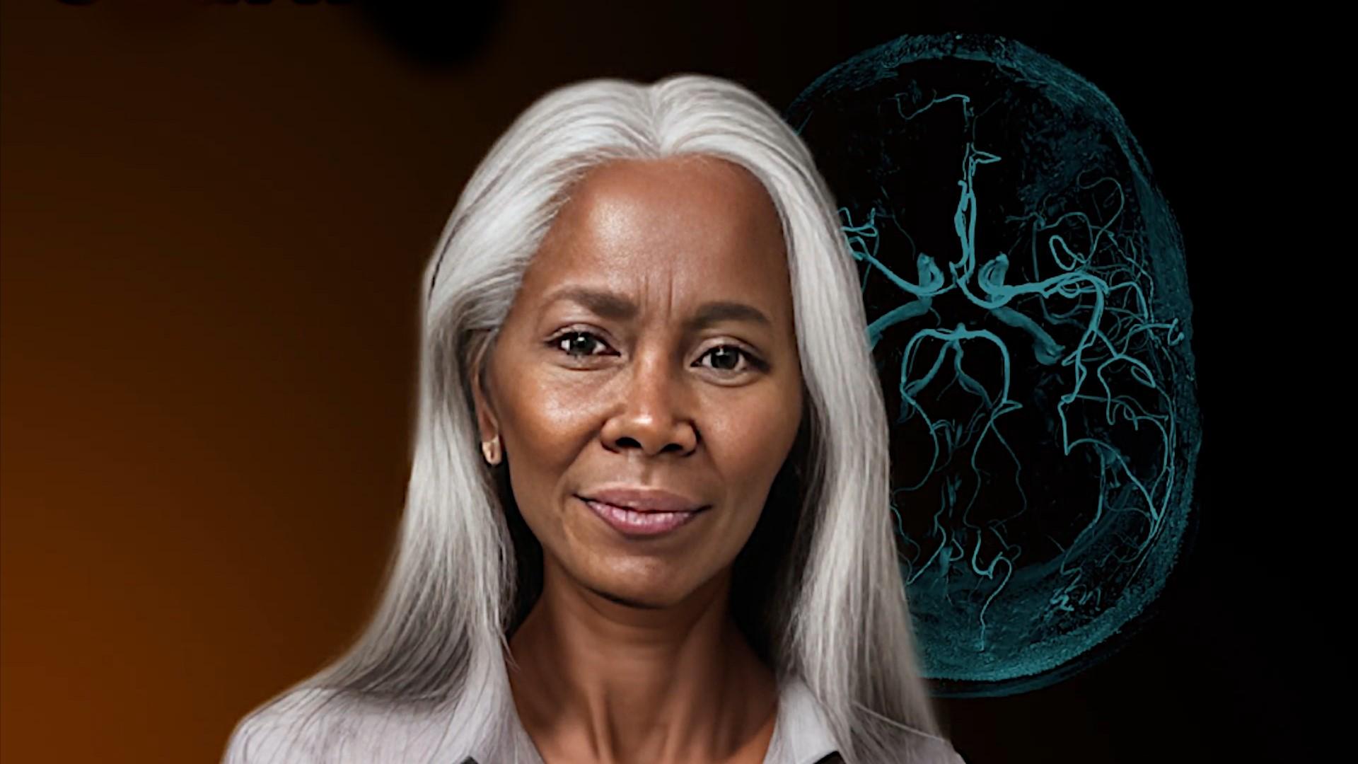 Secondary stroke prevention - Siemens Healthineers