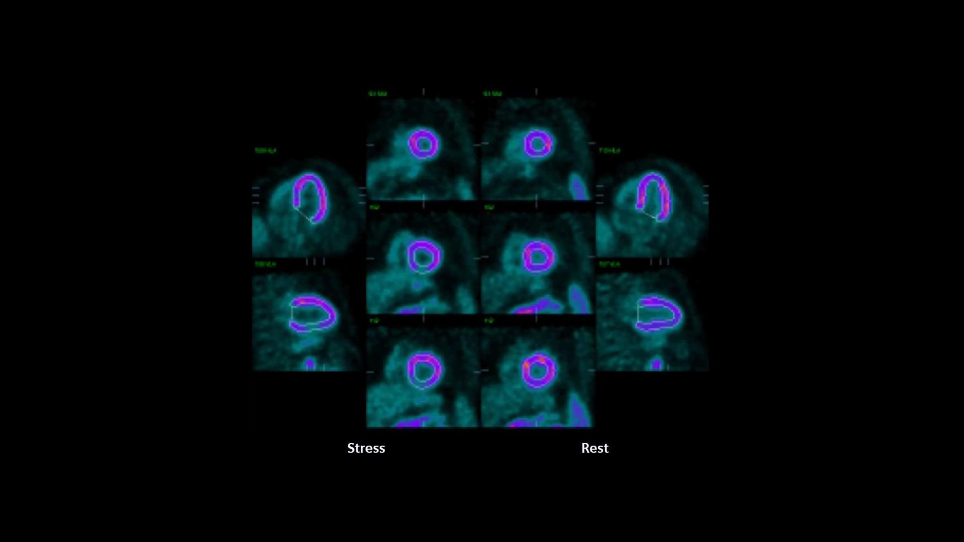 PET/CT delineation of multivessel coronary artery disease and post ...