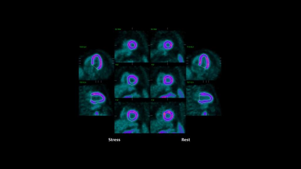 PET/CT delineation of multivessel coronary artery disease and post ...