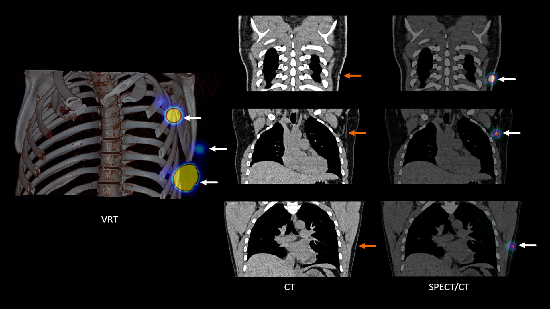 Symbia Pro.specta SPECT/CT Case Study Review - Siemens Healthineers