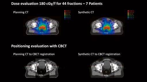 MR-only Radiotherapy Planning - Siemens Healthineers