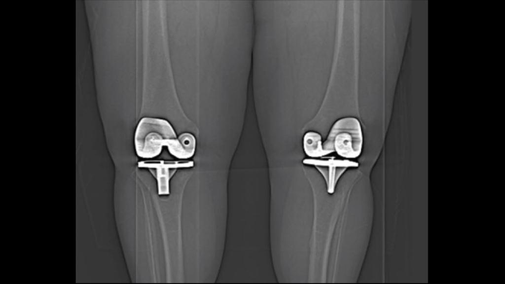 SPECT/CT Detection In TKA Prosthetic Loosening - Siemens Healthineers USA