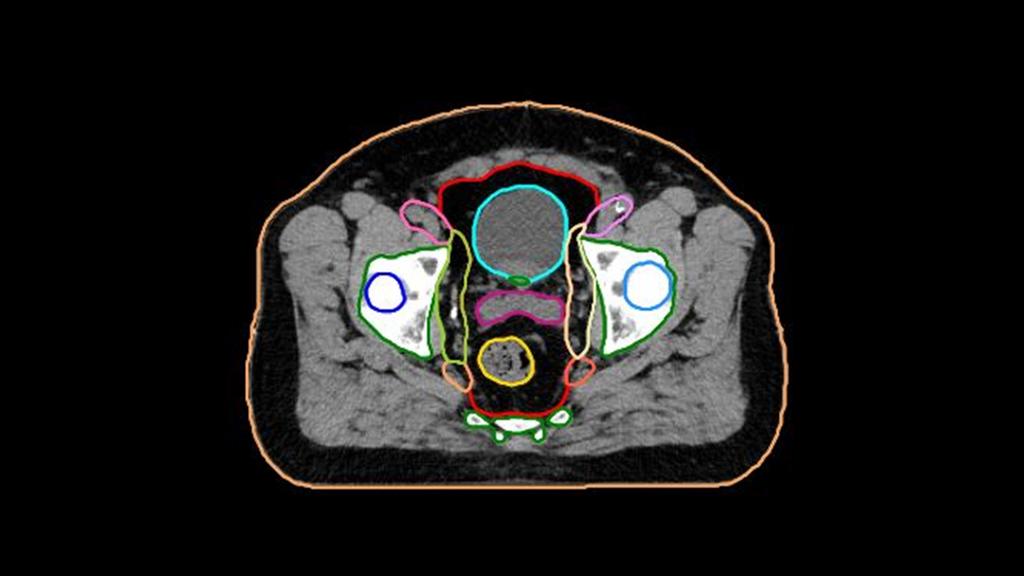 Autocontouring in Radiation Therapy - Siemens Healthineers - Siemens ...