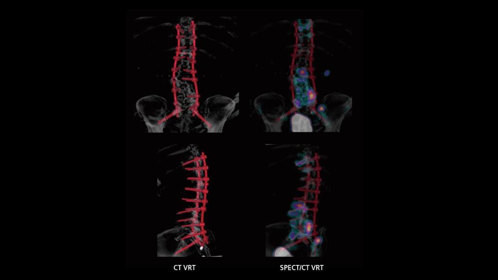 SPECT/CT imaging in the evaluation of pain following spinal fusion ...