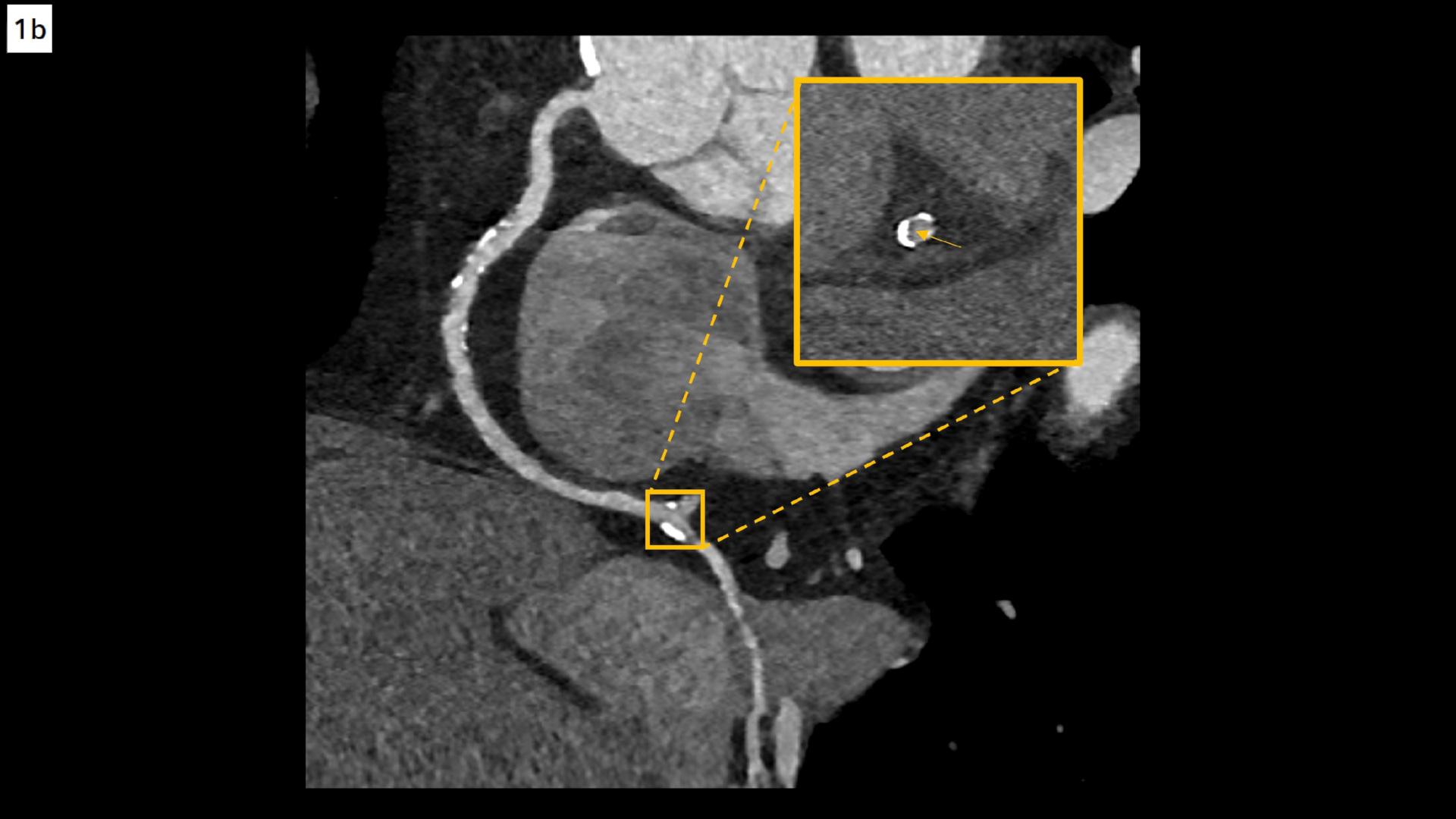 Beneath the calcified plaque in the distal right coronary artery ...