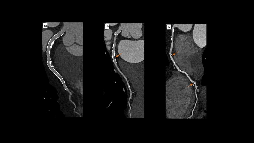 Multiple coronary stents – in-stent restenosis - Siemens Healthineers USA