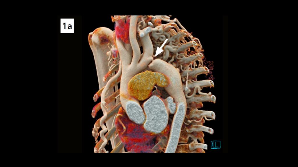 Severe aortic coarctation in an adult - Siemens Healthineers