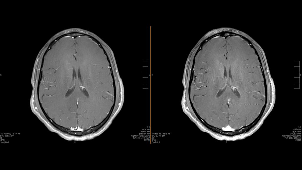 Pediatric protocols using Deep Resolve