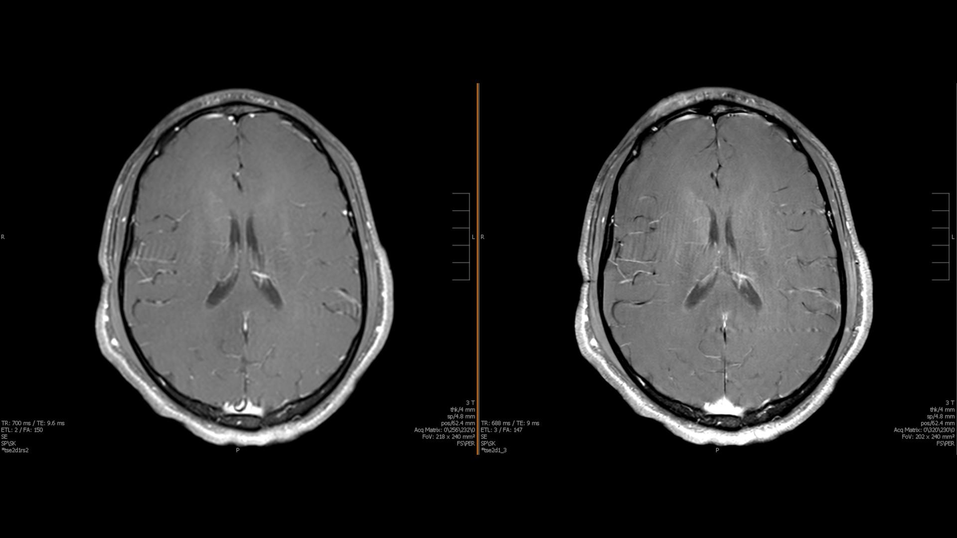 Pediatric protocols using Deep Resolve