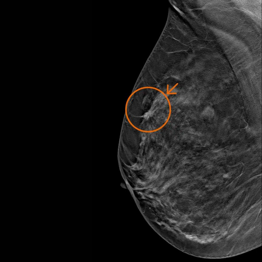 Dense breast screening & early detection resources - Siemens ...