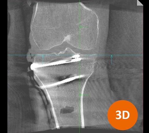 Intraoperative 3D imaging in orthopedic trauma surgery - Siemens ...