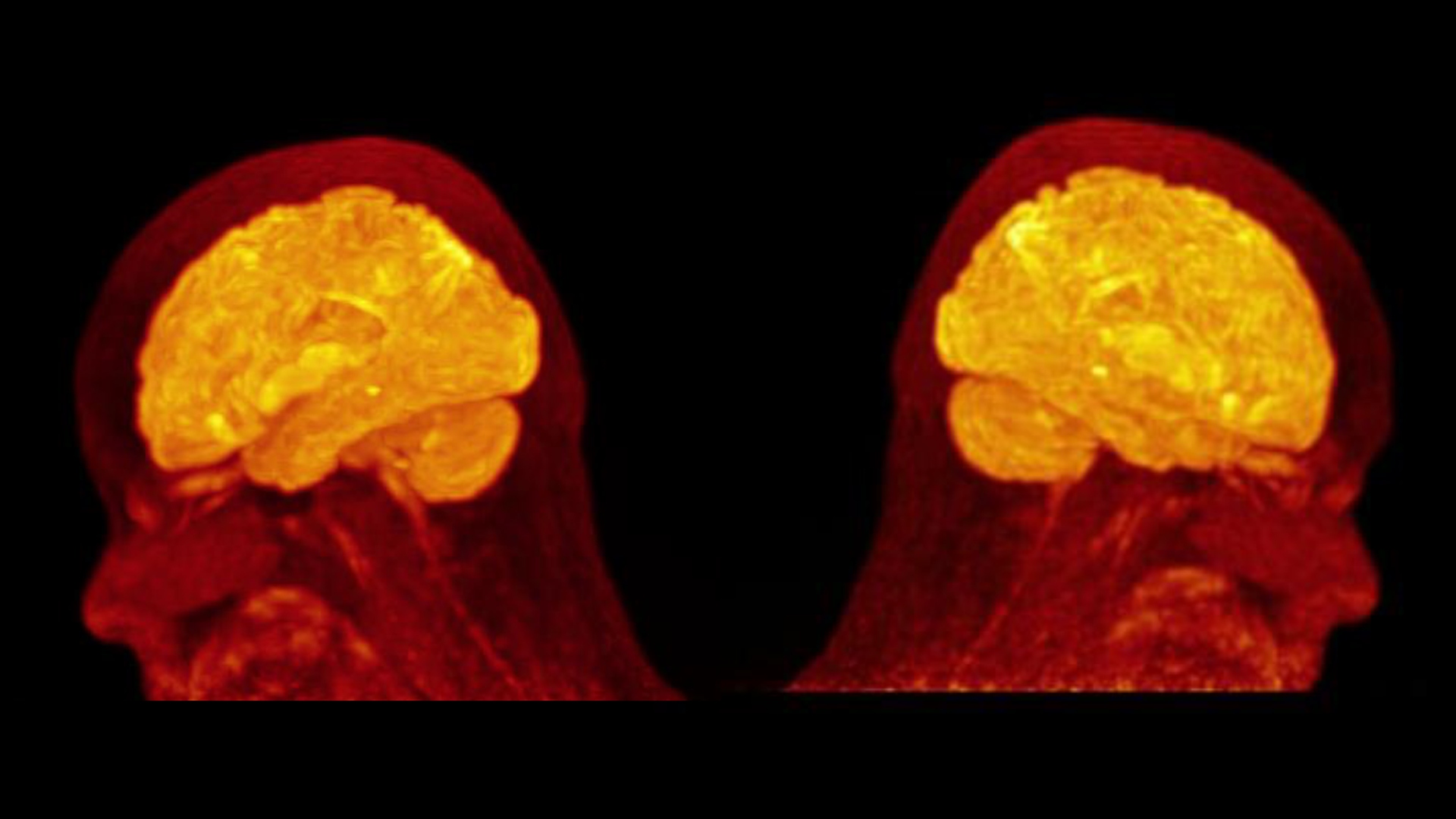 Biograph Vision PET/CT Scanner - Siemens Healthineers