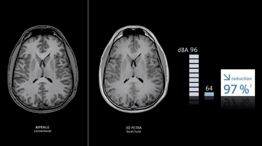 MRI for Alzheimer's disease - Siemens Healthineers USA