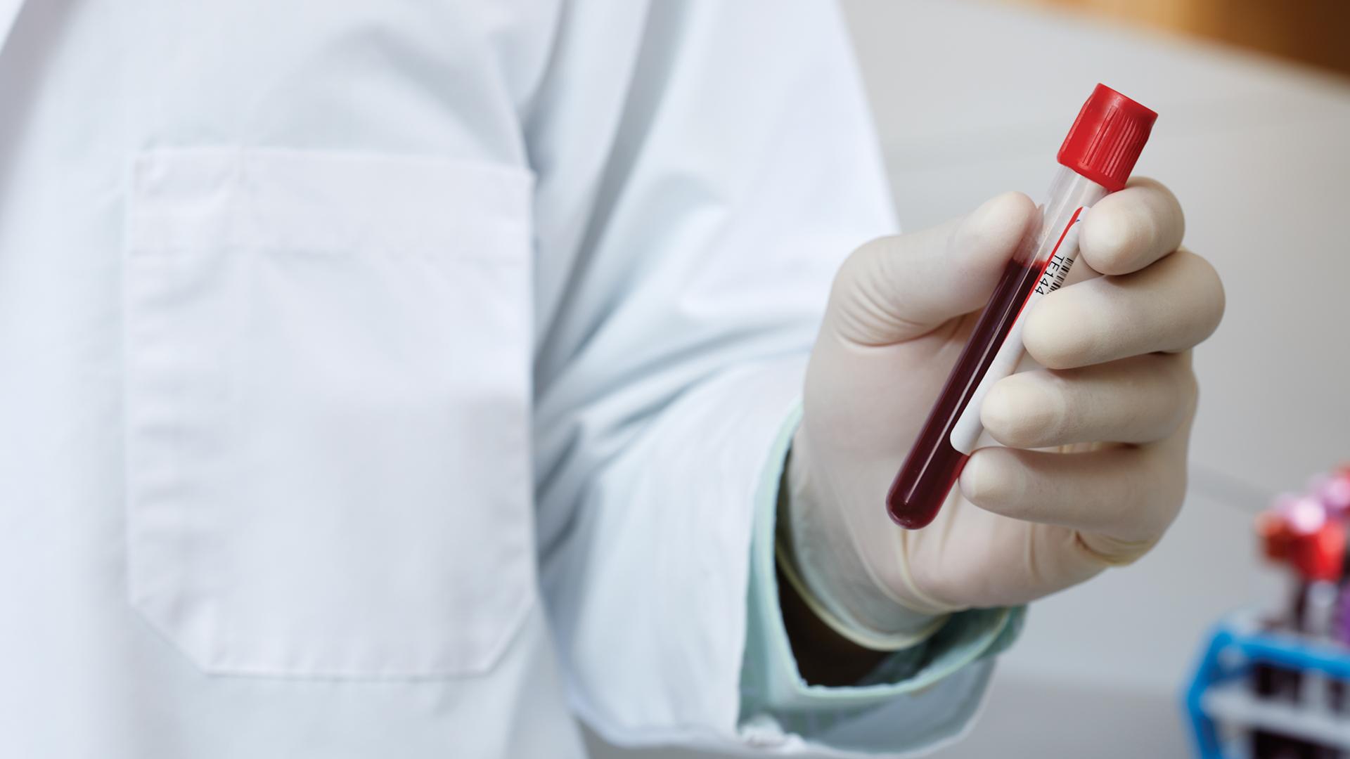 Innovating a non-invasive blood test for advanced liver fibrosis ...