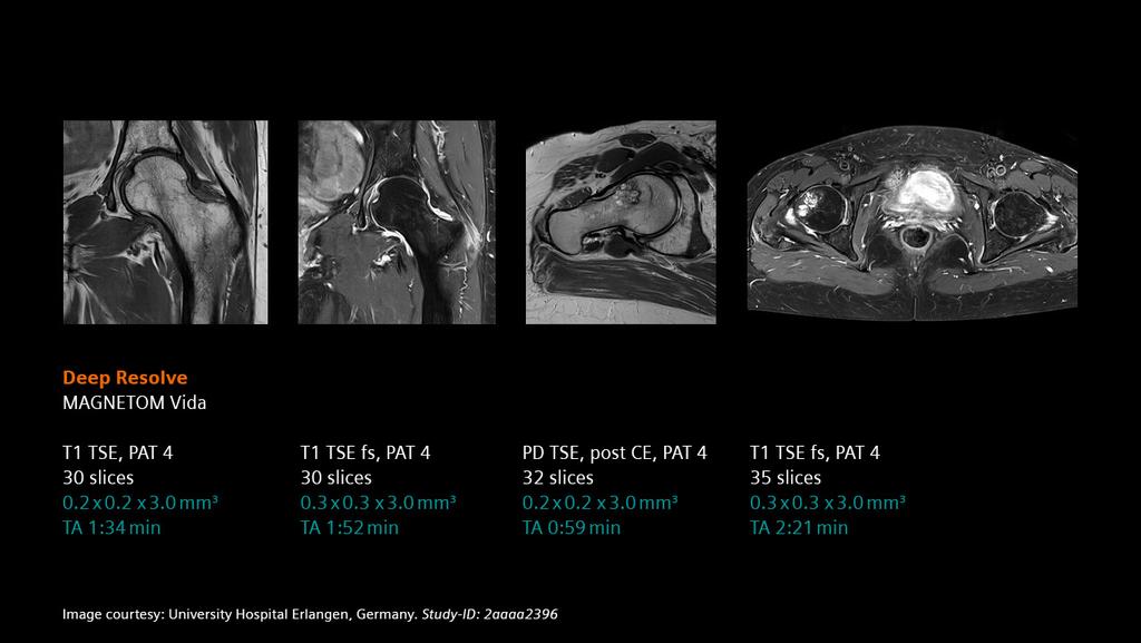 Deep Resolve - Siemens Healthineers