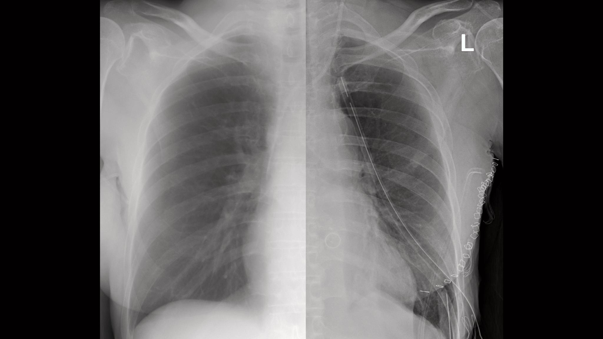 MOBILETT Impact - Siemens Healthineers