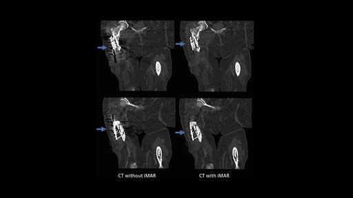 Localization Of Infection Site In Femoral Stabilization Pin - Siemens ...