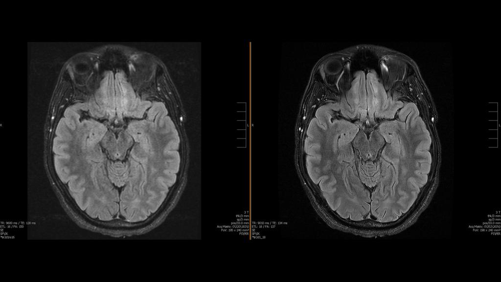 Pediatric protocols using Deep Resolve