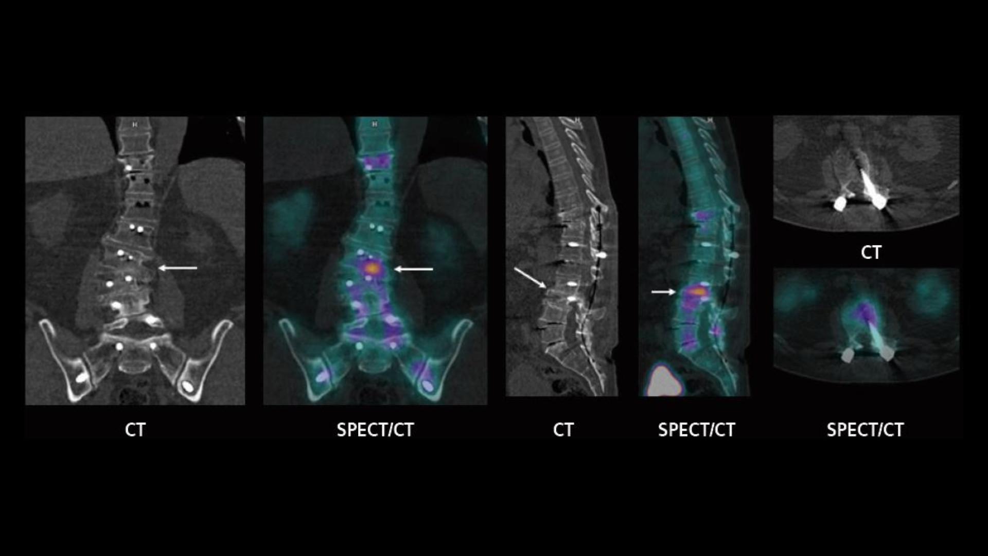 SPECT/CT imaging in the evaluation of pain following spinal fusion surgery - Siemens ...