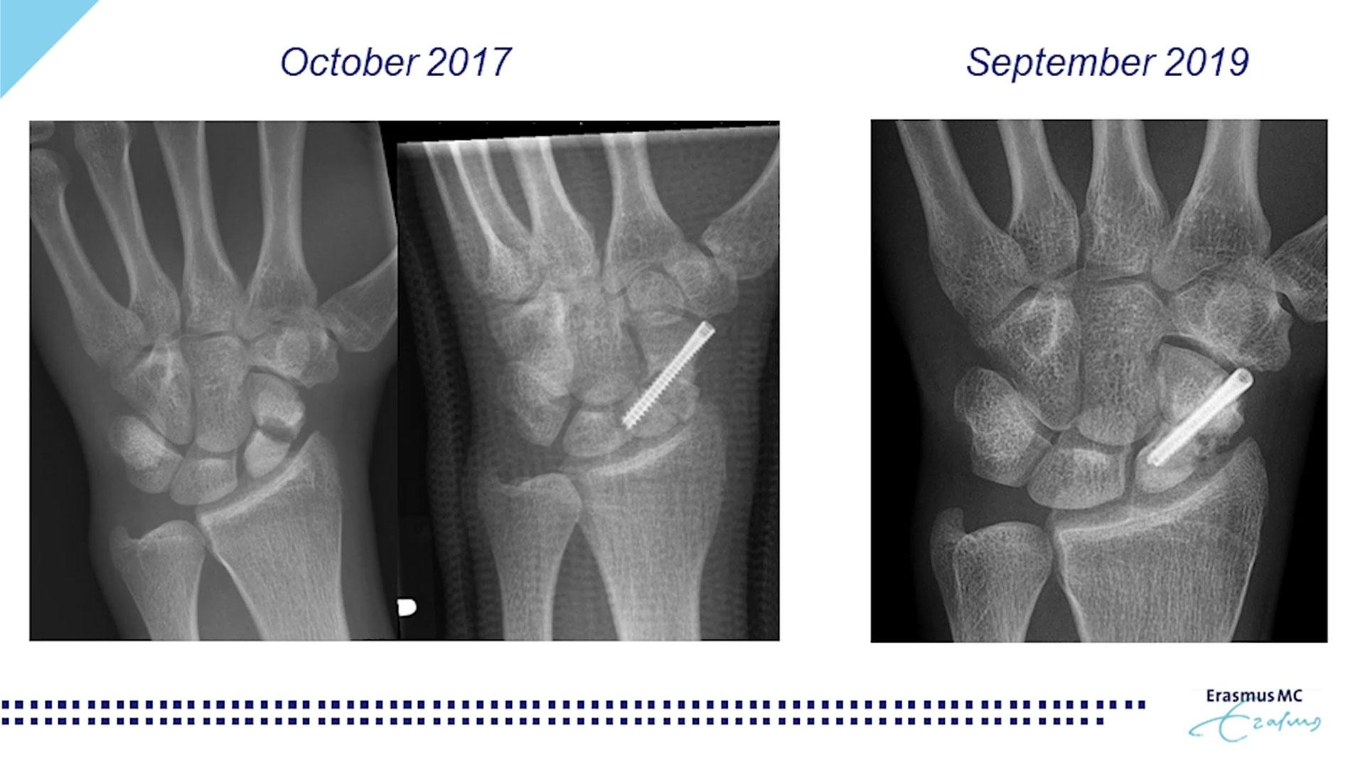 NAEOTOM Alpha – Musculoskeletal Cases