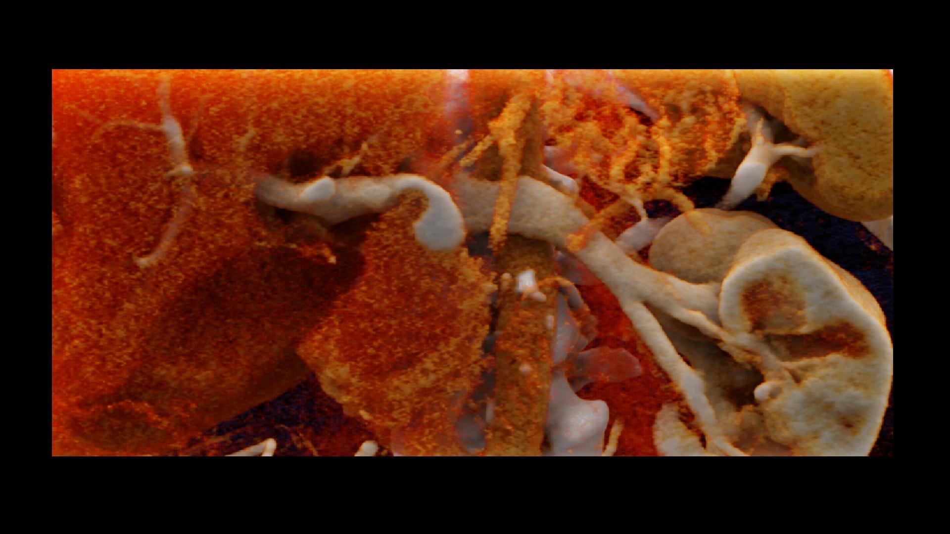 Atypical pancreatic neuroendocrine tumor secondary to metastatic renal ...