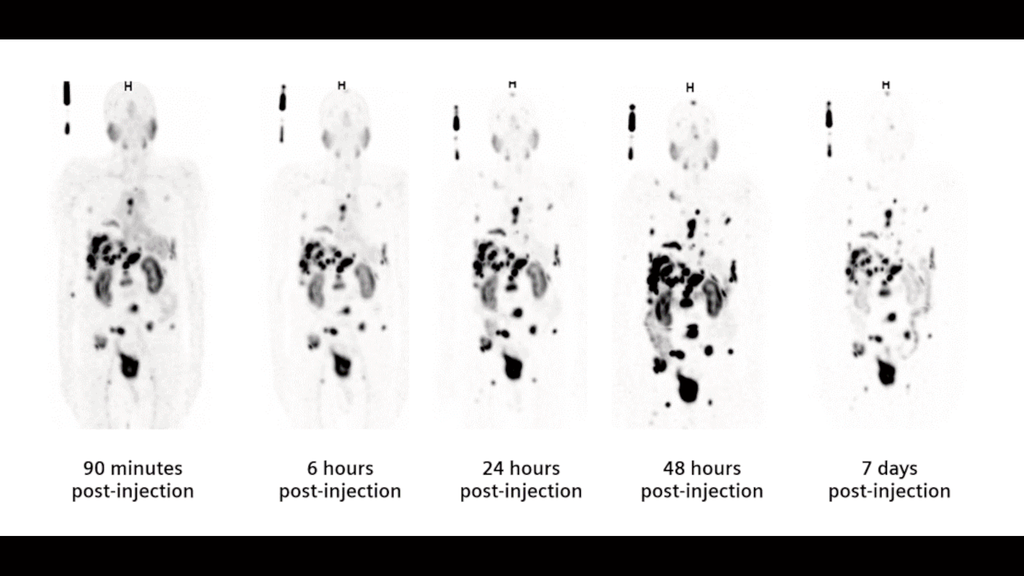 Tumor And Organ Dosimetry From Sequential Quantitative Spect Ct Siemens Healthineers