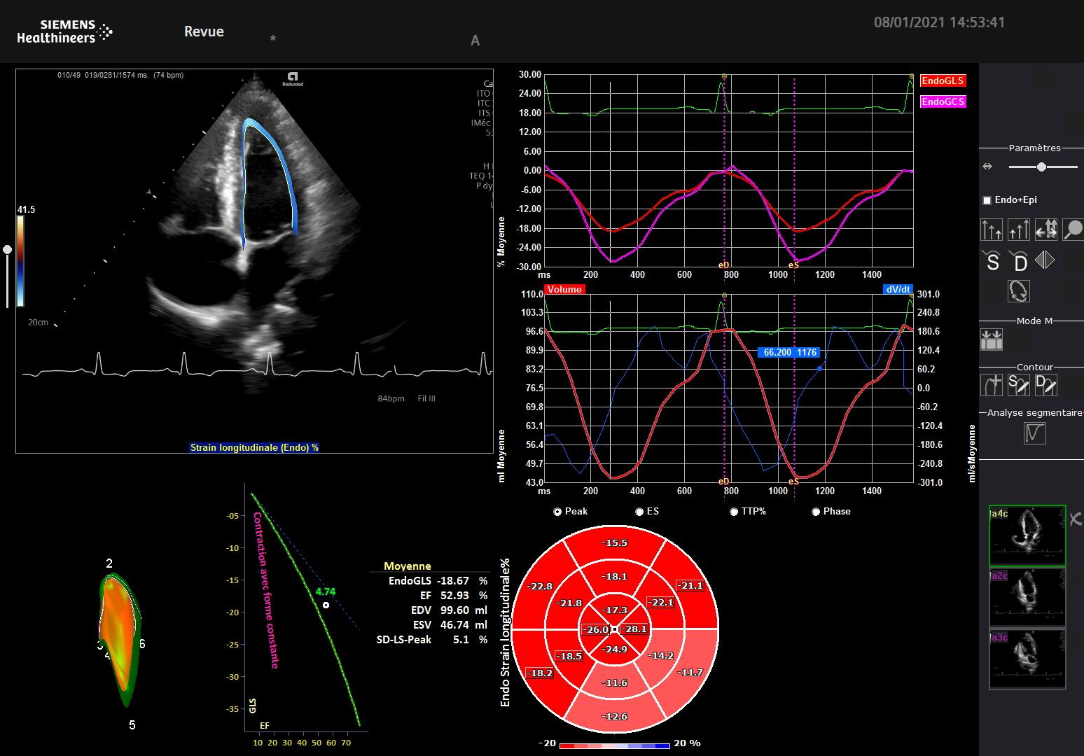 Rétrécissement aortique calcifié : écho-Doppler transthoracique ...