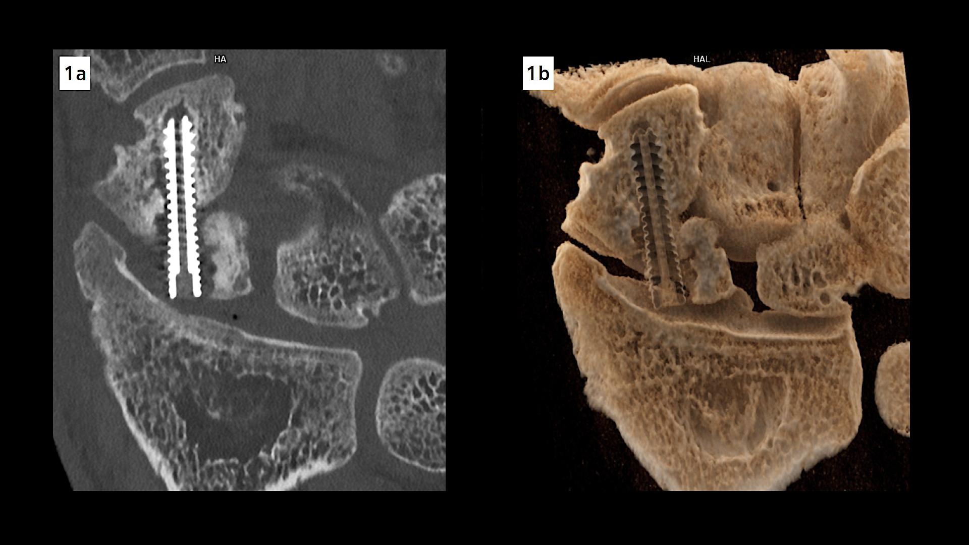 FOOSH injury with screw fixation of the scaphoid - Siemens Healthineers USA