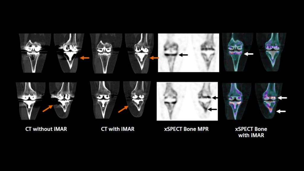 SPECT/CT Detection In TKA Prosthetic Loosening - Siemens Healthineers