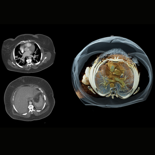 SOMATOM X.cite with myExam Companion - Siemens Healthineers USA