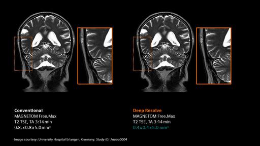 Deep Resolve - Siemens Healthineers