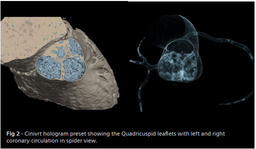Quadricuspid Aortic Valve (QAV) - A very rare congenital heart disease