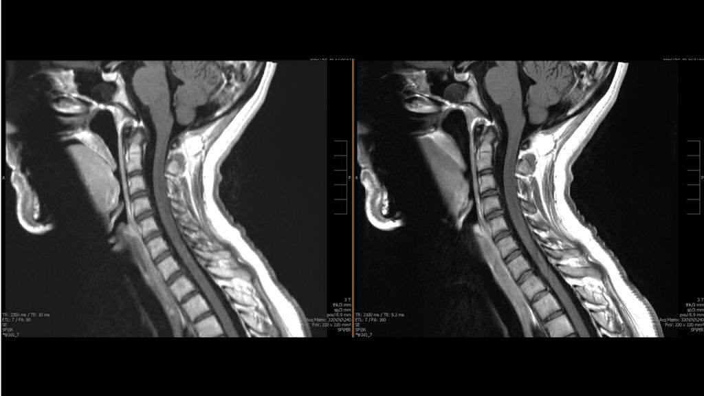 Pediatric protocols using Deep Resolve