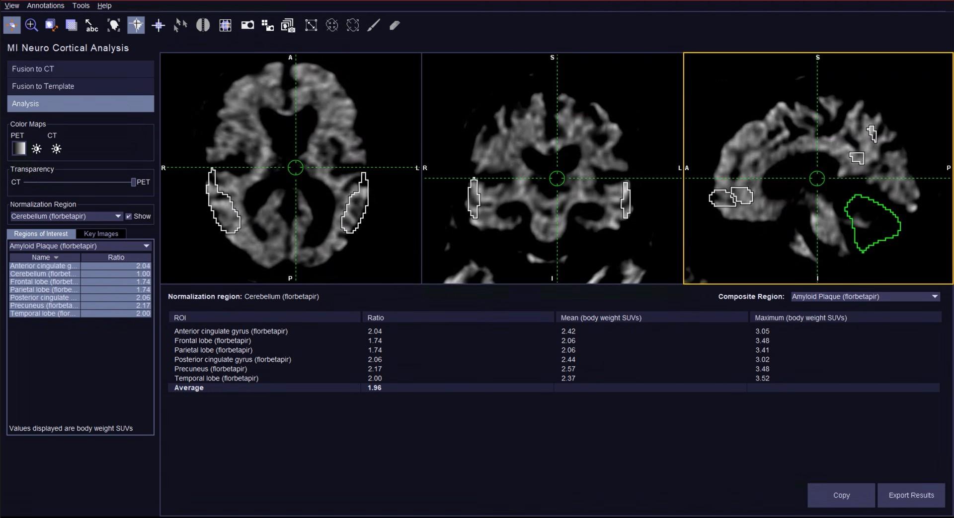 Beta-amyloid PET imaging for Alzheimer's disease - Siemens Healthineers
