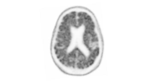 Beta-amyloid PET/CT imaging for Alzheimer's disease - Siemens ...