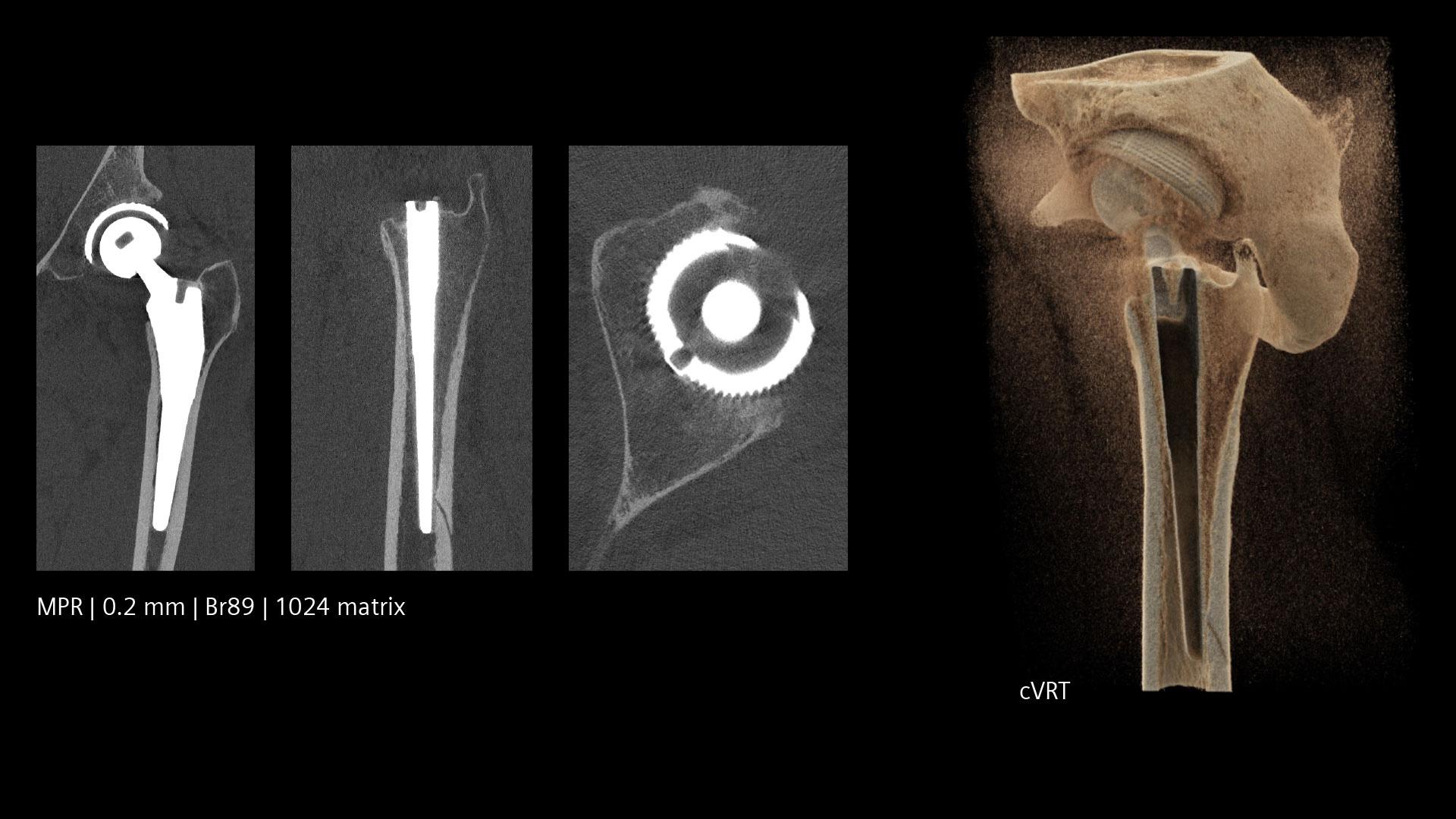 Photon-counting CT musculoskeletal imaging